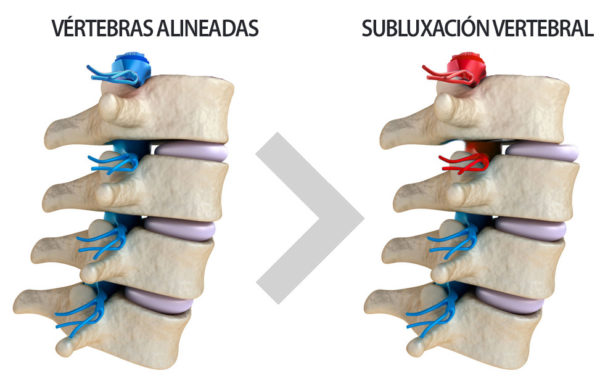 La subluxación vertebral - Barcelona Quiropractic
